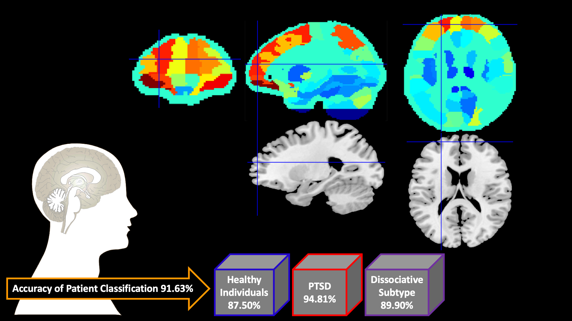 Using technology to diagnose PTSD and its subtypes | Homewood Research ...